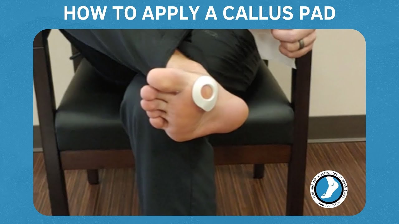 How to Apply Callus Pads | Foot and Ankle Associates of North Texas, LLP