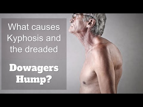 What Causes Kyphosis to evolve into a Dowagers hump