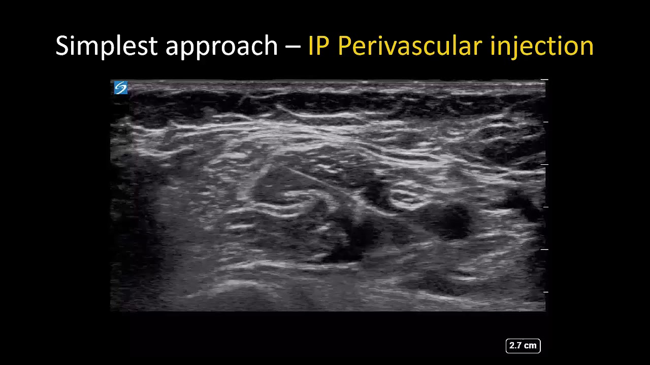 US-guided Axillary Brachial Plexus Block - the Simple Guide