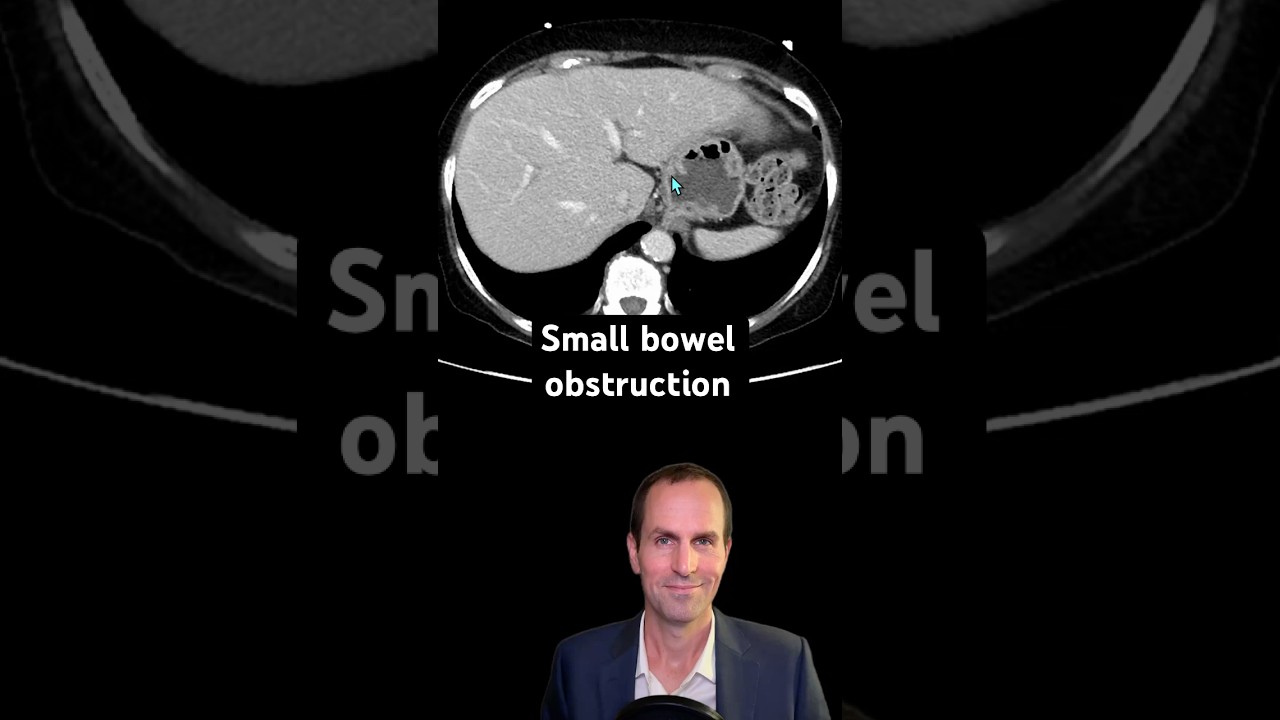 Abdominal CT Tutorials - Small bowel obstruction