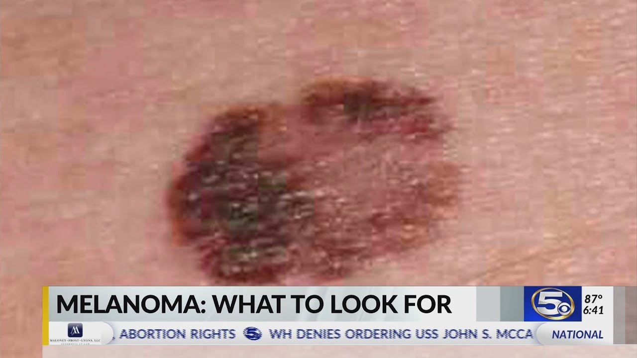 VIDEO: 5 ways to spot Melanoma