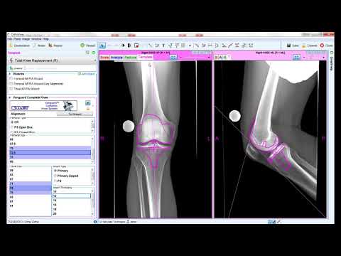 What's new in version 7.1 | Clinical Features | Materialise OrthoView 7.1 Tutorial