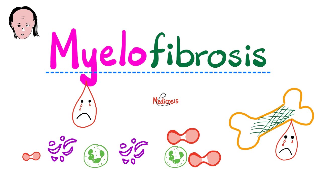 Primary Myelofibrosis (PMF) - Myeloproliferative Neoplasm - Bone Marrow Fibrosis