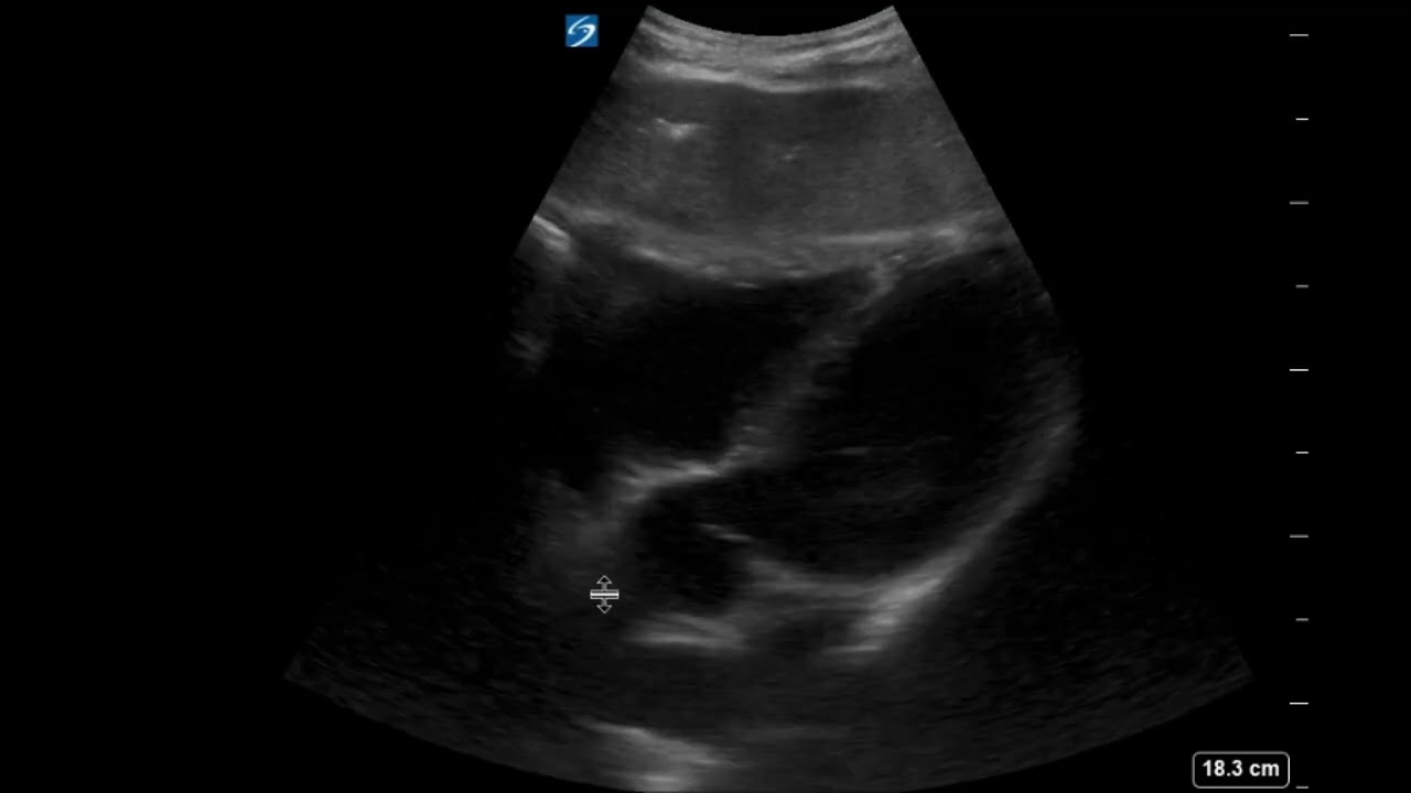 Pneumobilia on Ultrasound: Not All Air in the Liver Is Bad
