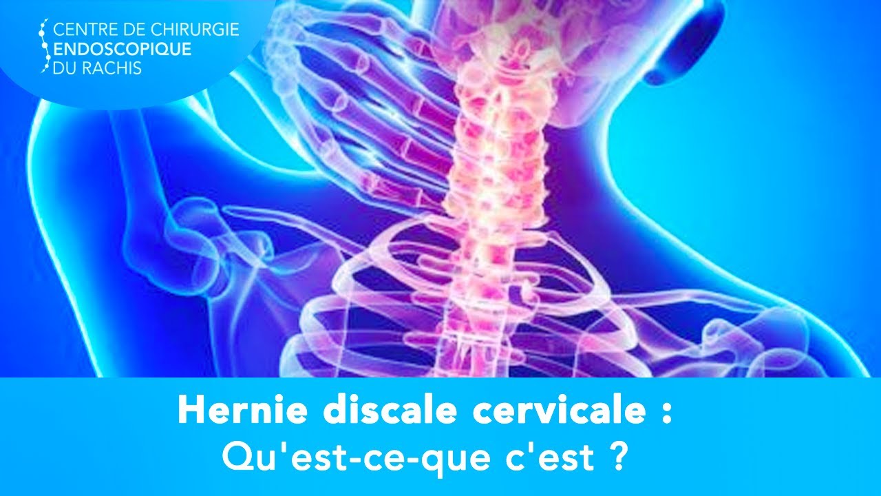CERVICAL DISC HERNIATION: What is it?