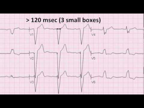 Left Bundle Branch Block