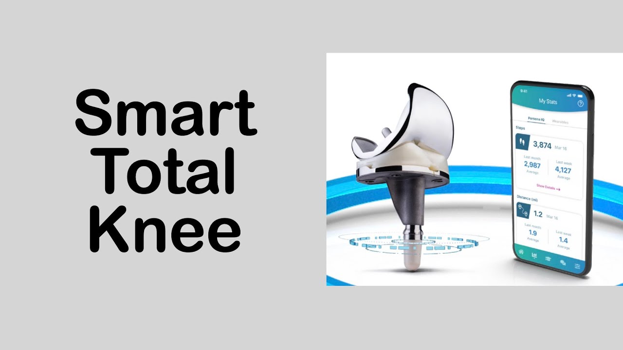 Smart Knees: The Medical Breakthrough You Need