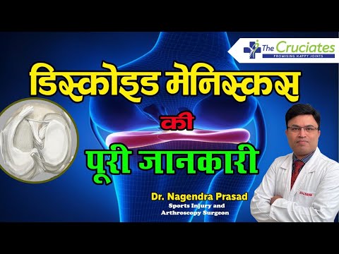 डिस्कोइड मेनिस्कस I Discoid meniscus I Meniscal Tear #discoidmeniscus #meniscustear #kneelocking