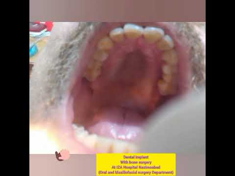 #implant #dental#imamzainulabideen #hospital #karachi #pakistan#nazimabad no 1 0236608991_3