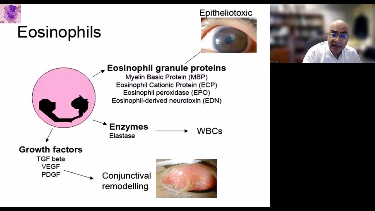 Lecture: Vernal Keratoconjunctivitis
