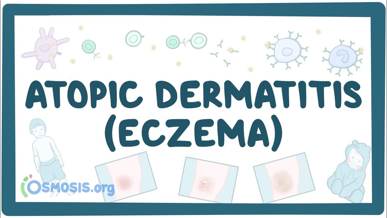 Atopic dermatitis (eczema) - causes, symptoms, diagnosis, treatment, pathology
