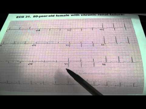 EKG ECG electrocardiogram Cardiologist Cardiology www.drbenzur.com