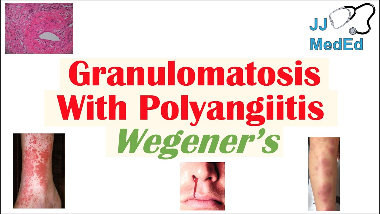 Granulomatosis with Polyangiitis (Wegener’s granulomatosis) | Symptoms, Diagnosis, Treatment