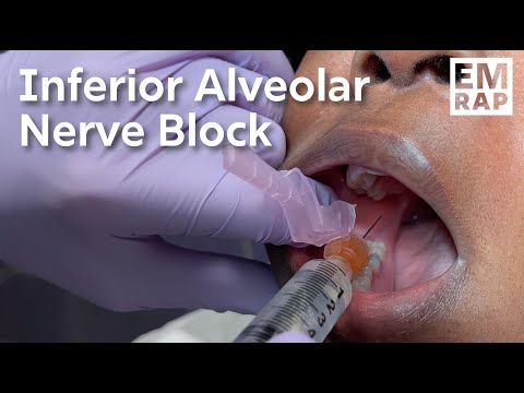 Inferior Alveolar Nerve Block