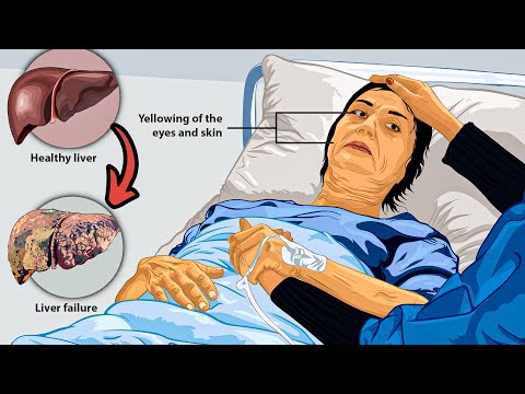 Acute Liver Failure: Symptoms, Causes and Treatment