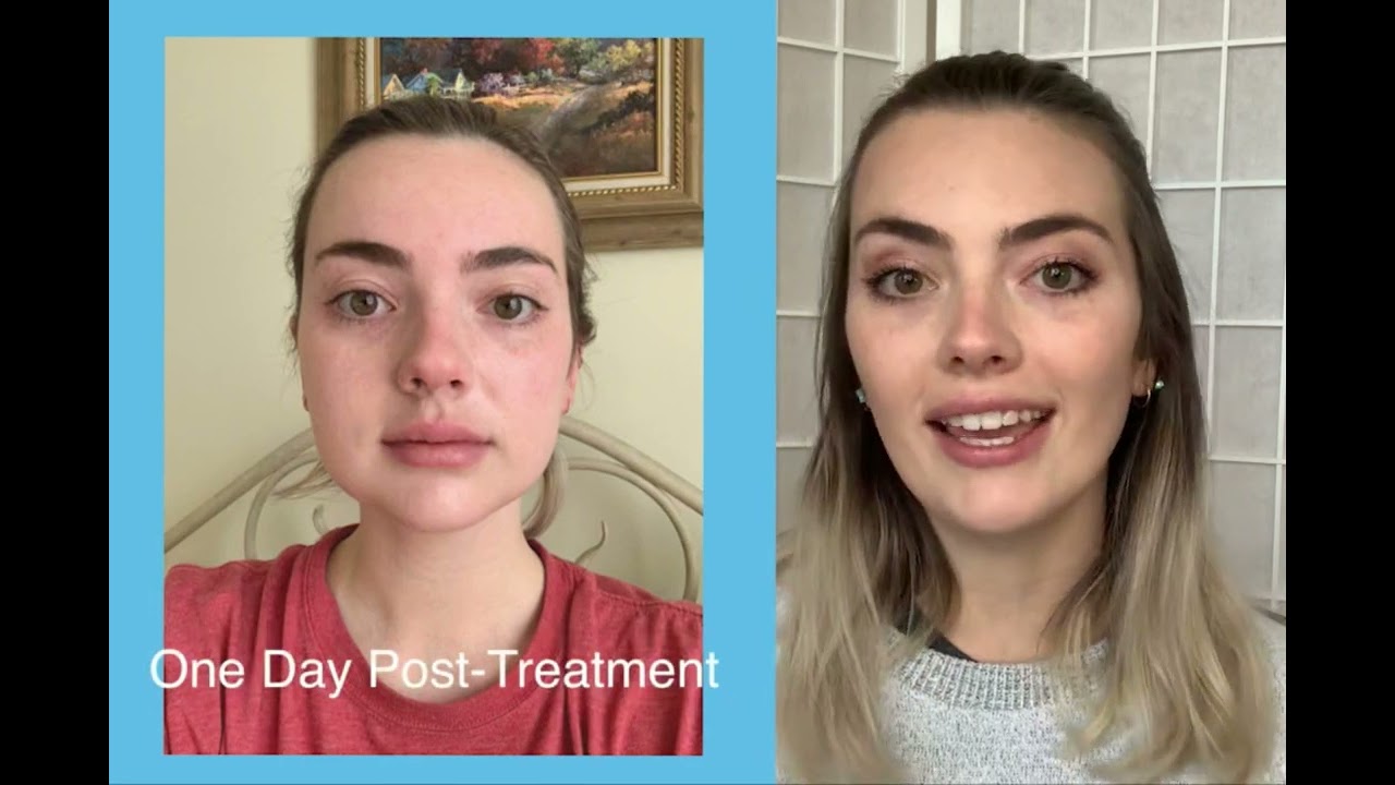 LM Buccal Fat Removal Testimonial
