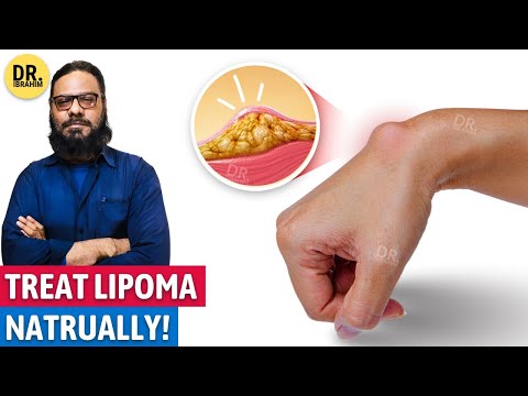 Lipoma Ka Qudrati Ilaj | Natural Remedies for Lipoma | Urdu/Hindi | Dr. Ibrahim