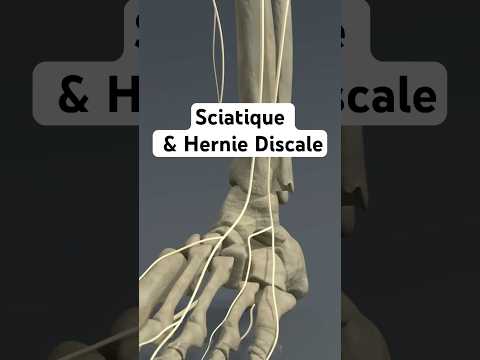 Sciatique & Hernie Discale #maldedos #lombaire #sciatique #herniediscale