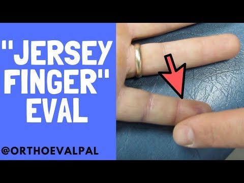 "Jersey Finger" Injury/Avulsion of the Distal Phalynx