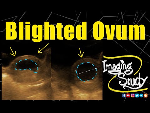 Blighted Ovum || Ultrasound || Case 145