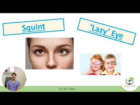 What is a Squint (Strabismus)? What is a Lazy Eye (Amblyopia)? I Dr Shaz Rehan, 2020