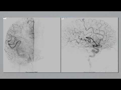 Motor cortex arteriovenous malformation