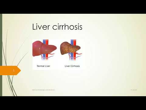 Liver Cirrhosis: Definition, Causes, Signs and Symptoms, Investigation and Management