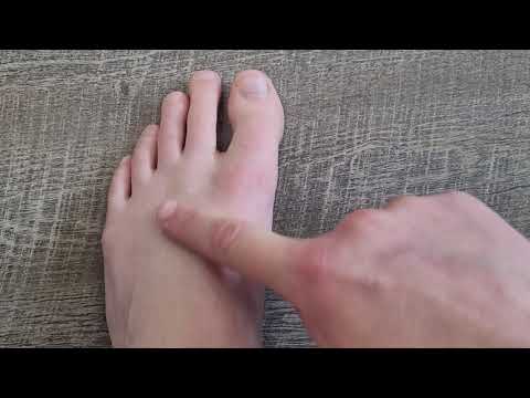 Why are my toes bent?