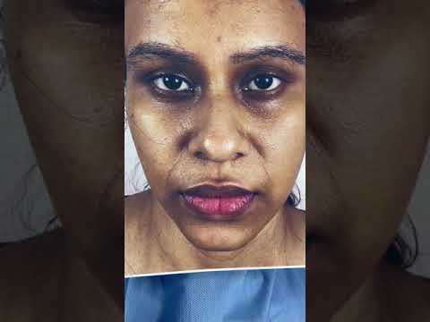Before and After Facemakeover Surgery in India