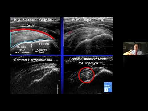 Shoulder Replacement in 2021 - J.R. Rudzki, M.D., M.Sc.