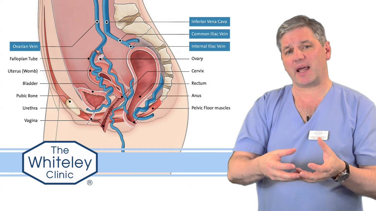 Pelvic Congestion Syndrome (PCS) explained