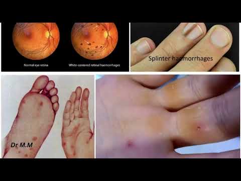 Infective Endocarditis Diagnosis: Master the Modified Duke Criteria