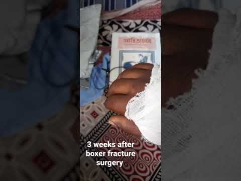 3 weeks after boxer fracture surgery