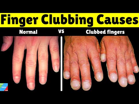 Finger Clubbing | Finger (Nail) Clubbing Causes | Grades of Finger Clubbing