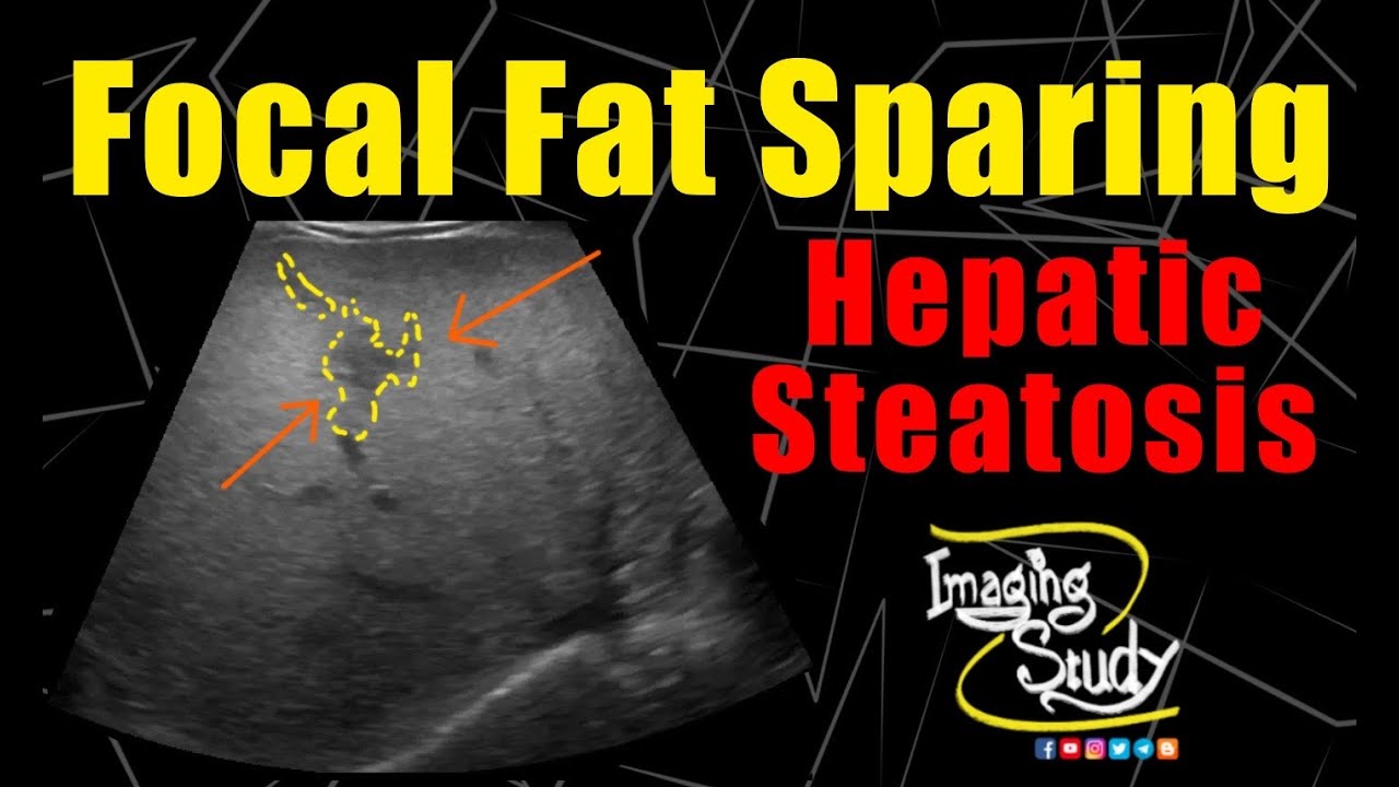 Understanding Hepatic Focal Fat Sparing: A Case Study | Galaxy.ai