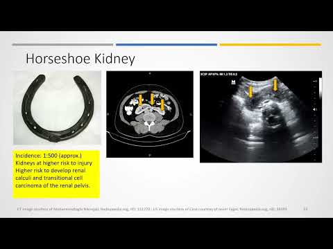 Horseshoe Kidney