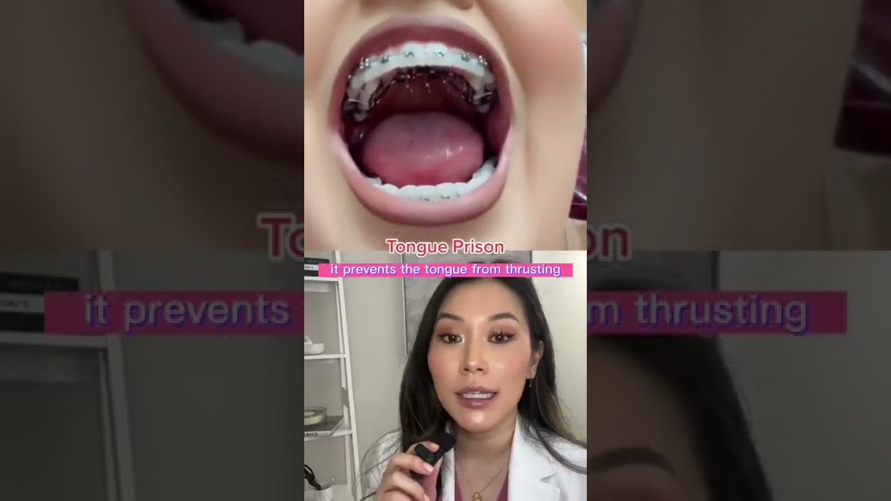 Tongue prison! #orthodontics #dentist #teeth #braces