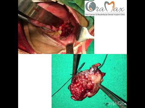 Carcinoma Of Left Retromolar Trigone