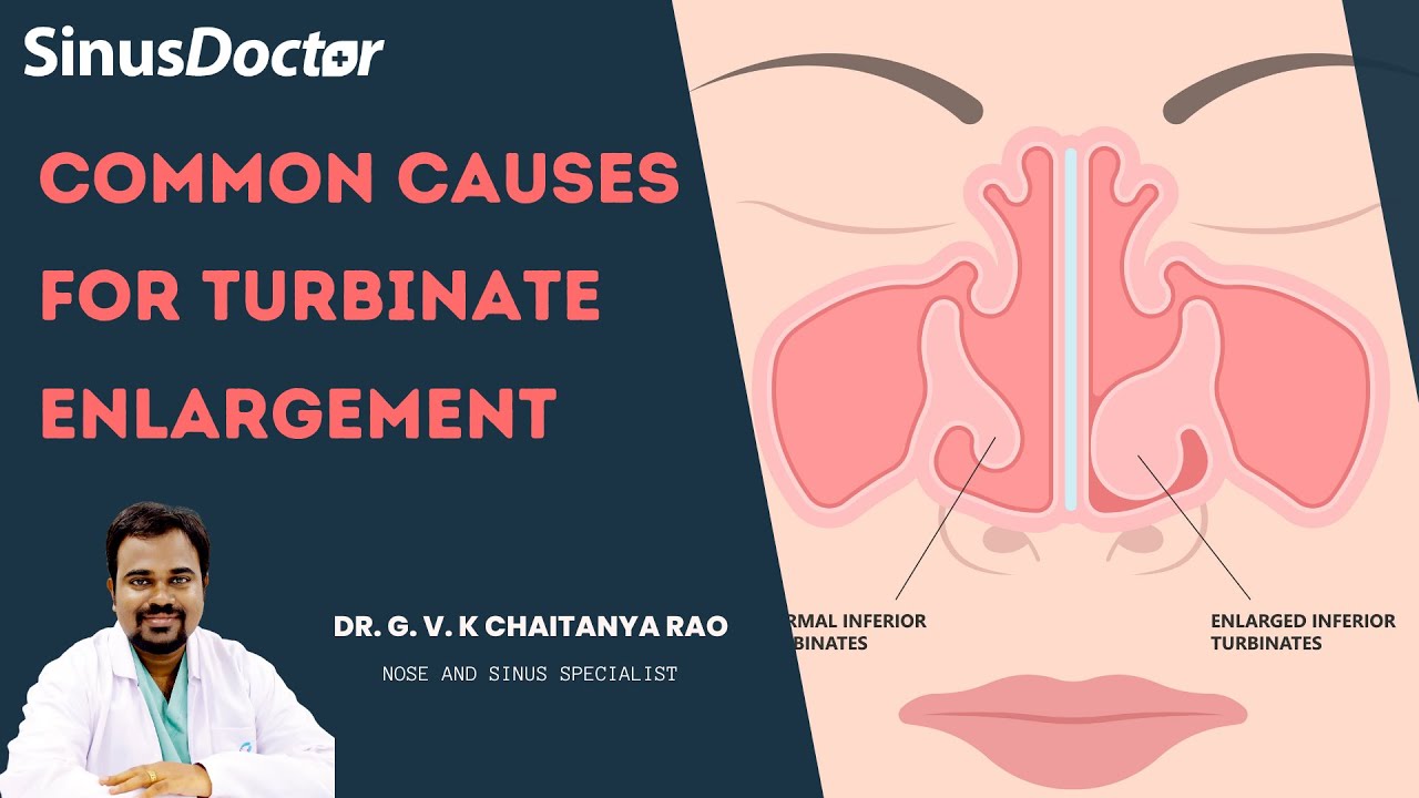 Causes for turbinate enlargement