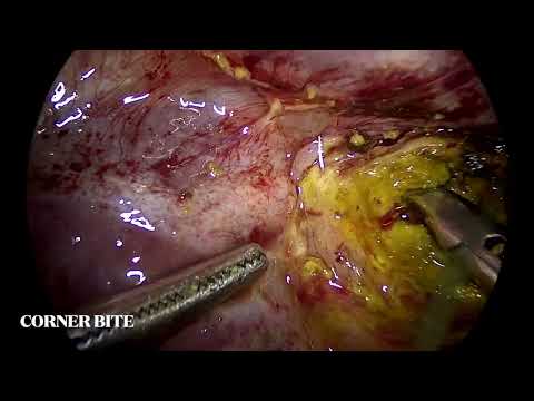 Laparoscopic Roux-en-Y Hepaticojejunostomy for Post-Cholecystectomy Type 3b Benign Biliary Stricture