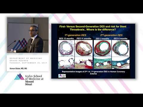 Evolution of Dual Antiplatelet Therapy After Coronary Stent Implantation: From STARS to TWILIGHT