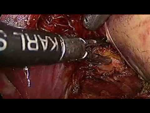 Lap Roux en y Hepaticojejunostomy
