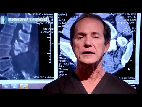 Epidural Steroid For Lumbar Spinal Stenosis Pros and Cons by Dr. Tony Mork
