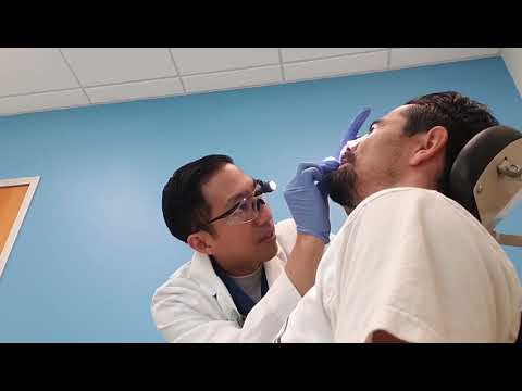 Deviated Septum Nose Surgery (Stent Removal)