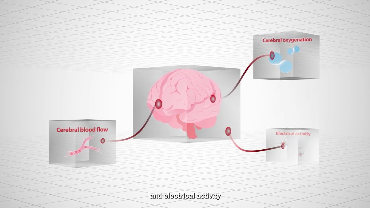 NeuroSight for brain monitoring CAA