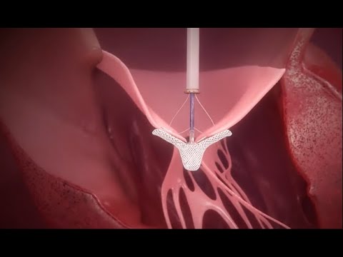 TEER Procedure with MitraClip Therapy