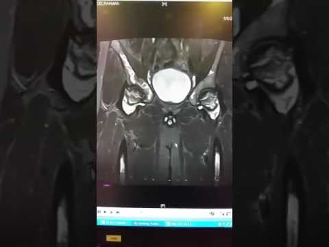MRI of bone infarcts at the pelvis