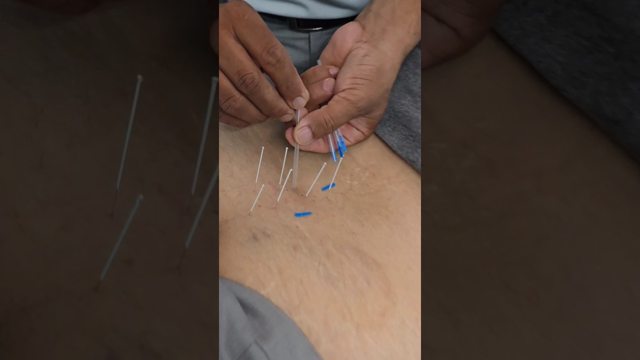 sciatica pain acupuncture