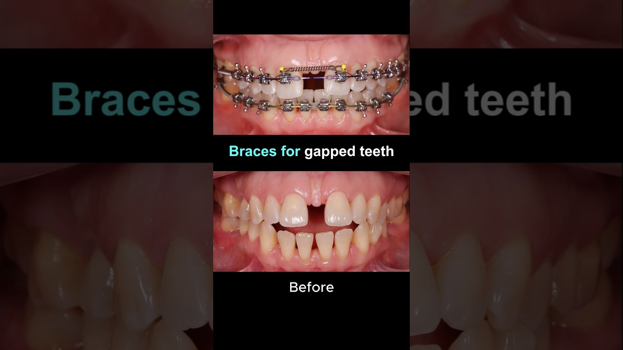 Braces for gapped teeth #braces #dentist #orthodontist
