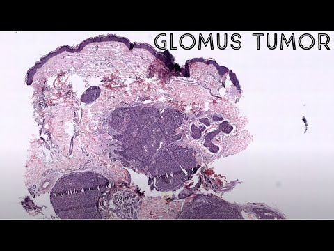 Glomus tumor under the microscope (pathology dermpath dermatology dermatopathology)